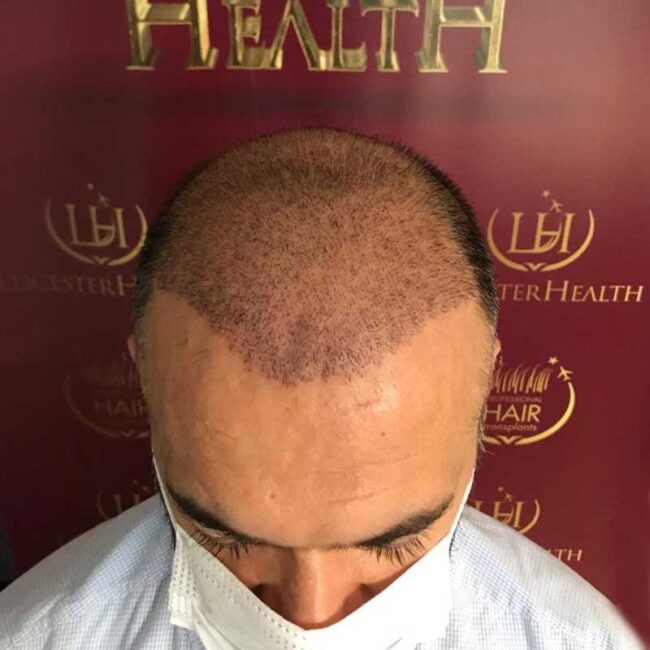 Haartransplantatie | Leicester Haarkliniek